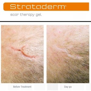 Strataderm Silicone Scar Therapy Gel 50g Soften & flatten Scars Reduces ...